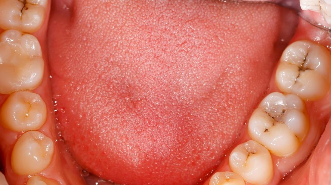 Tooth-Colored Fillings in Concord NH | White Park Dental Blog